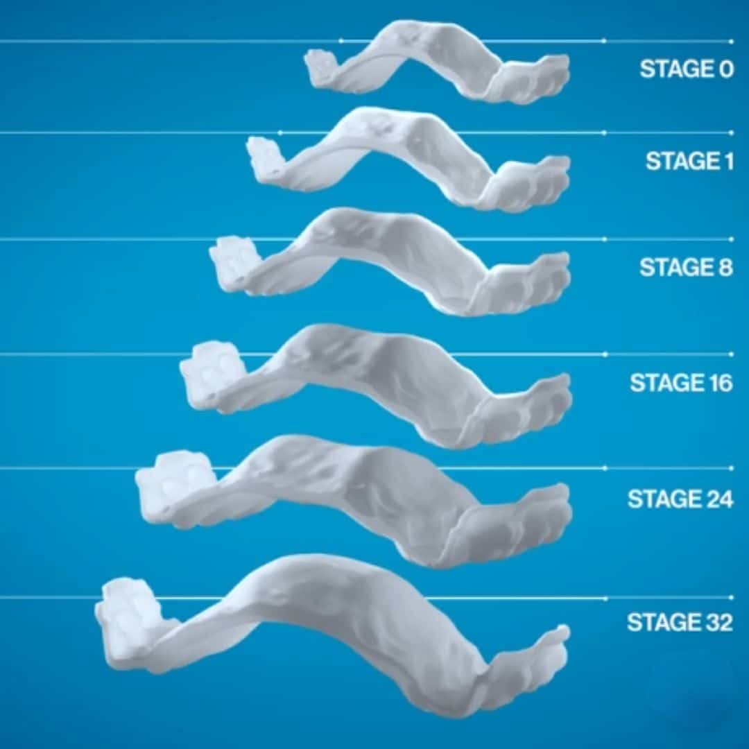 Palate Expanders San Diego CA | Smile Arc Pediatric Dentistry