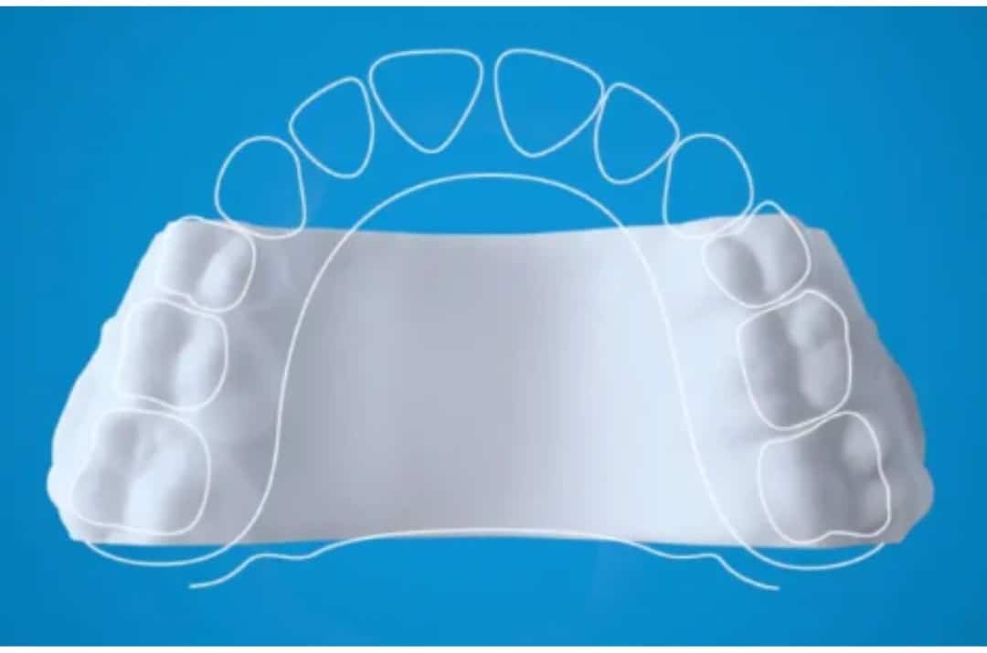 Palate Expanders San Diego CA | Smile Arc Pediatric Dentistry